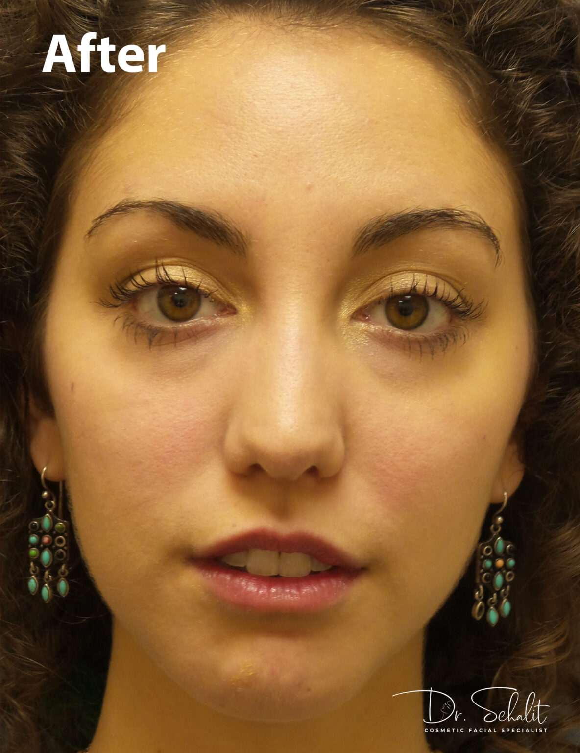 Chin Implant 1 - Dr. Schalit Cosmetic Facial Specialist