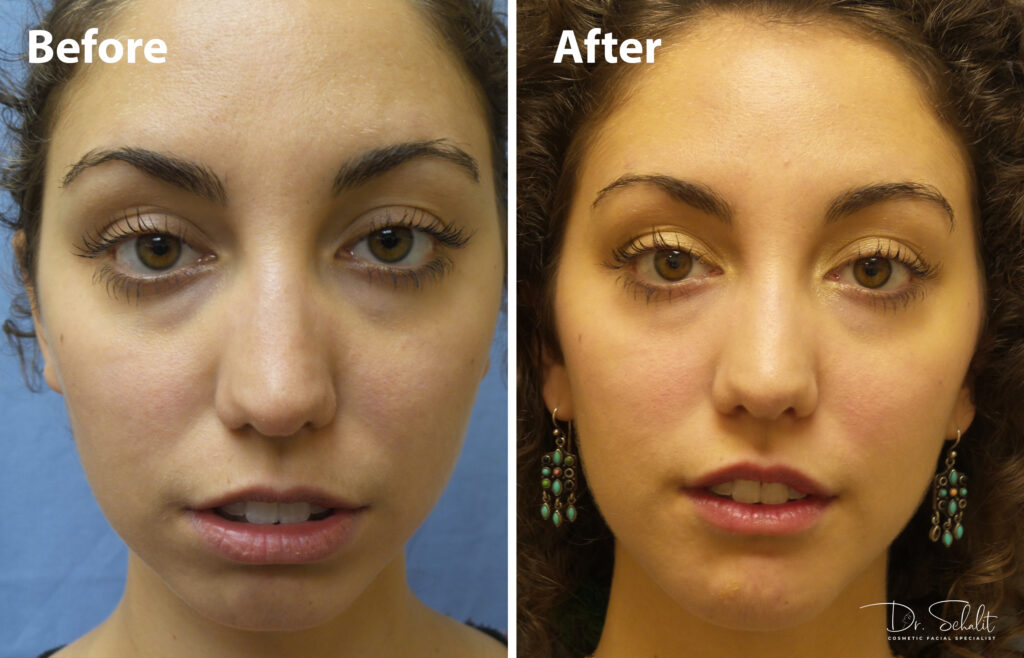 Chin Implant 1 - Dr. Schalit Cosmetic Facial Specialist