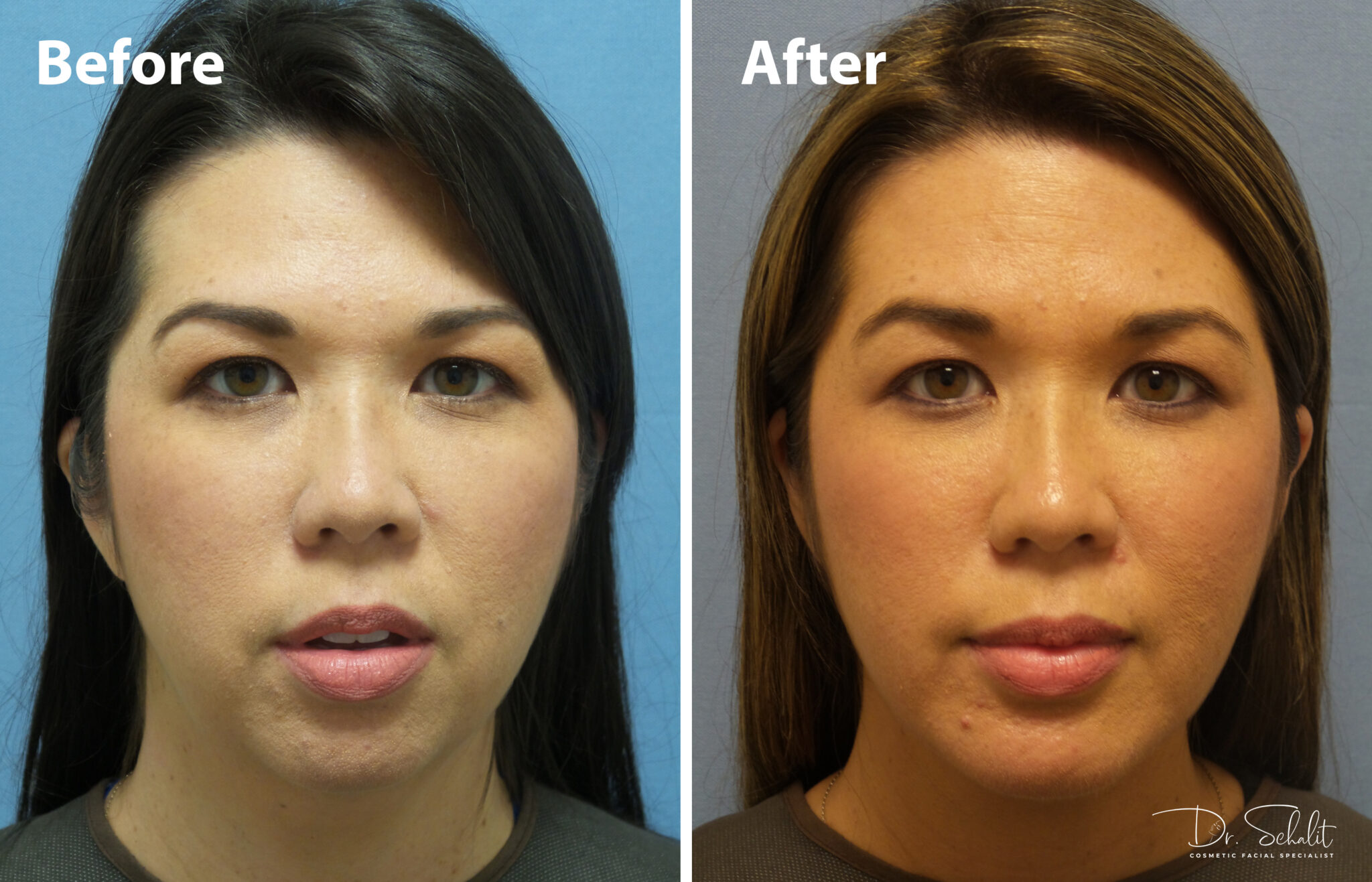 Chin Implant 4 - Dr. Schalit Cosmetic Facial Specialist