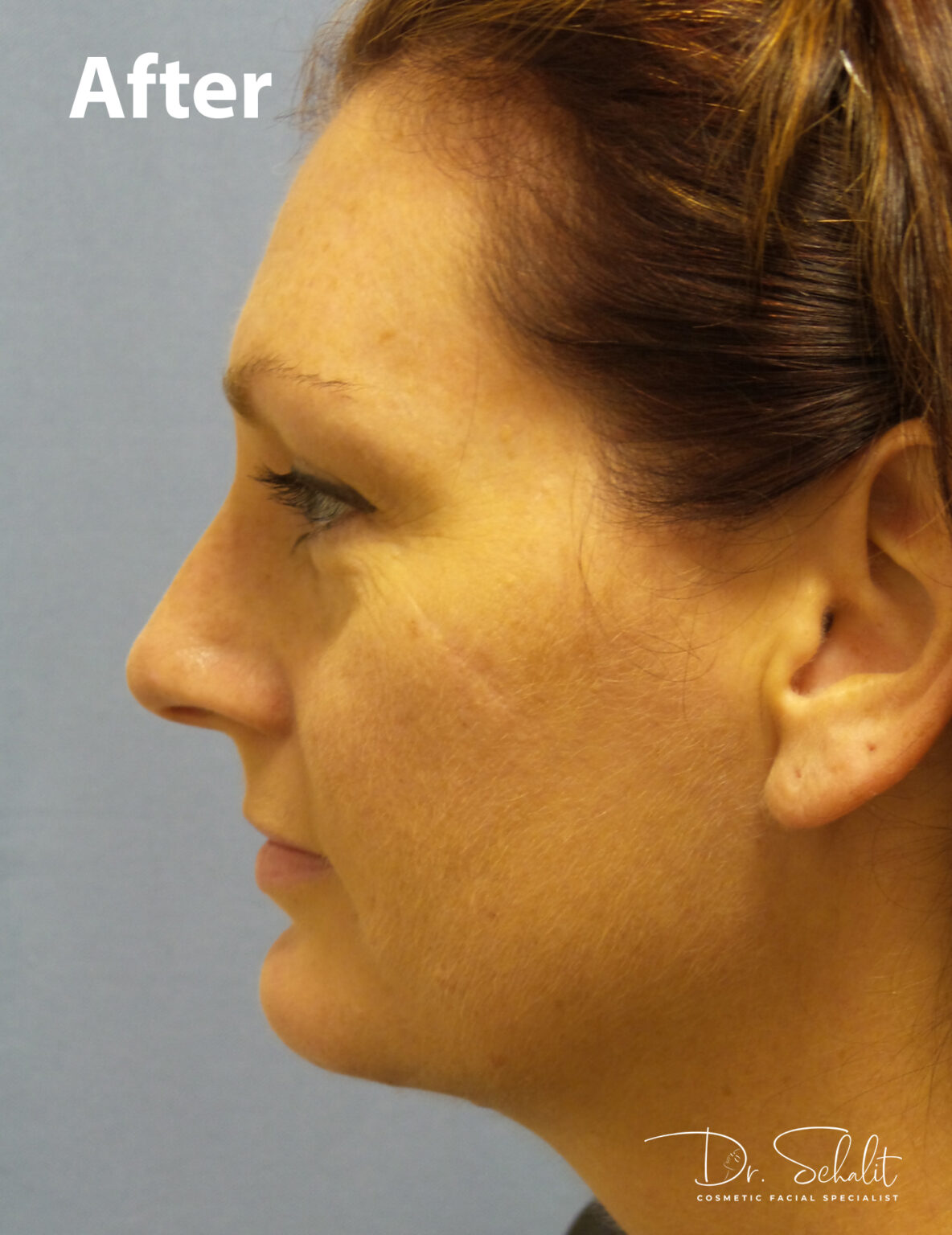 Chin Implant 5 - Dr. Schalit Cosmetic Facial Specialist