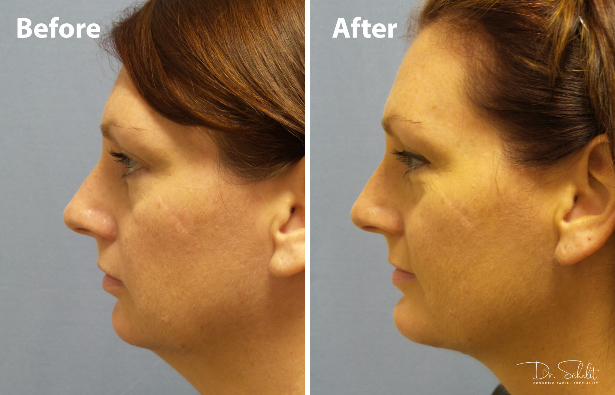 Chin Implant 5 - Dr. Schalit Cosmetic Facial Specialist