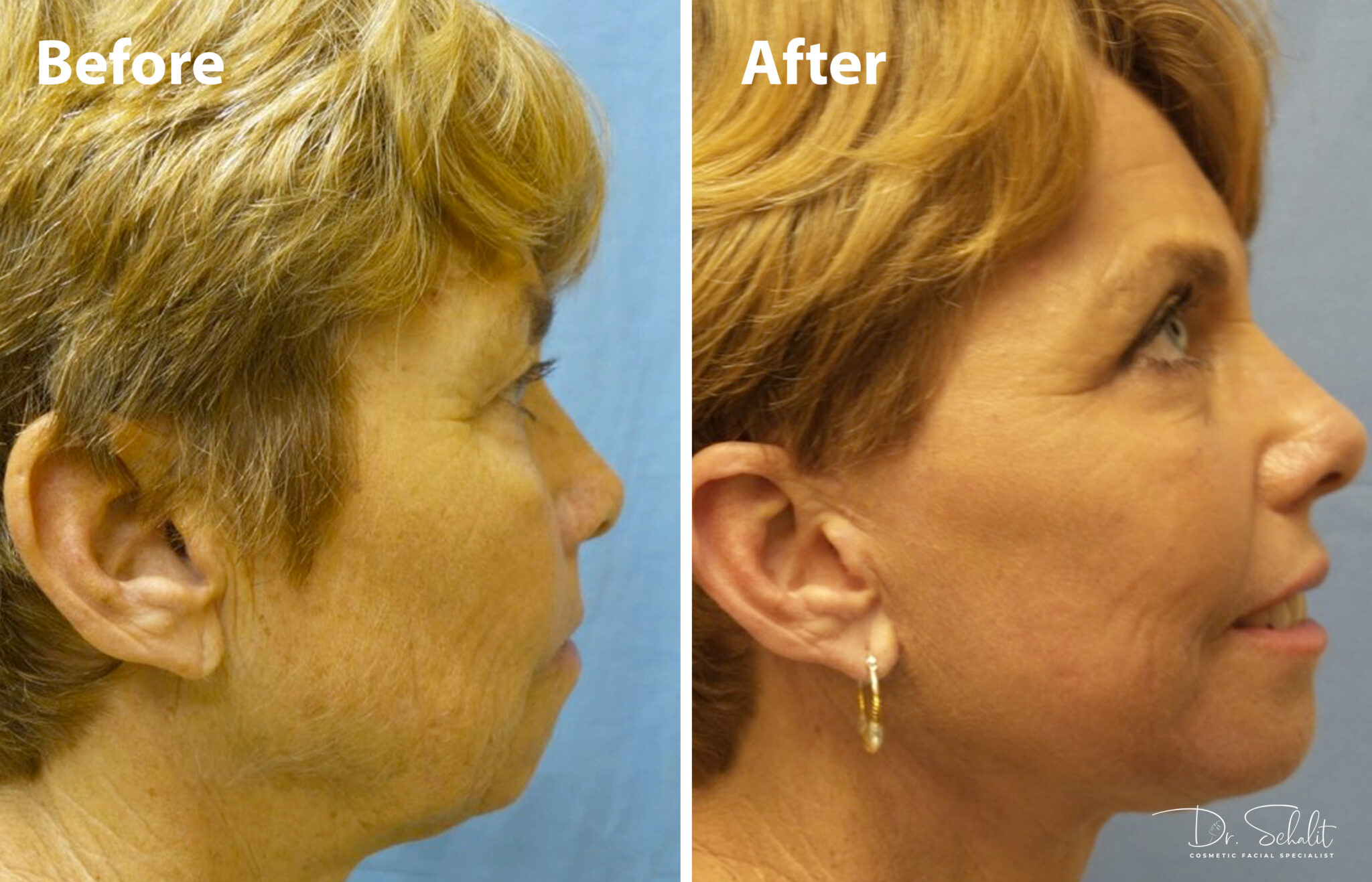 Chin Implant 6 - Dr. Schalit Cosmetic Facial Specialist