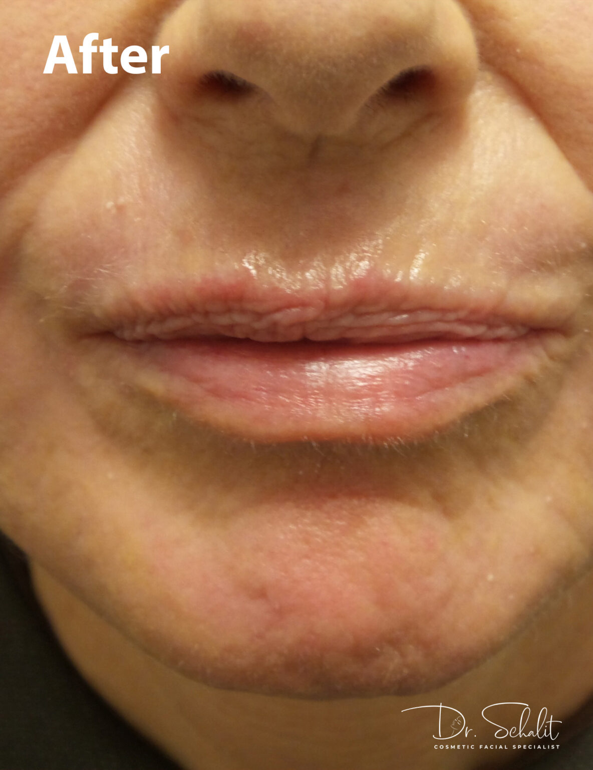 Erbium YAG Laser 2 - Dr. Schalit Cosmetic Facial Specialist
