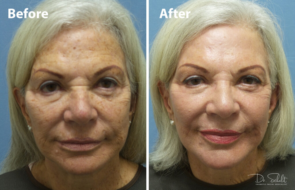 Erbium YAG Laser 3 - Dr. Schalit Cosmetic Facial Specialist