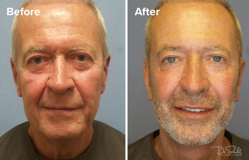 Face & Neck Lift 3 - Dr. Schalit Cosmetic Facial Specialist