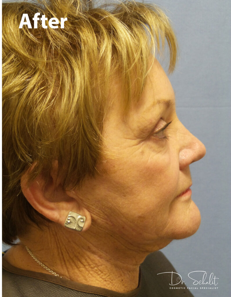 Face & Neck Lift 3 - Dr. Schalit Cosmetic Facial Specialist