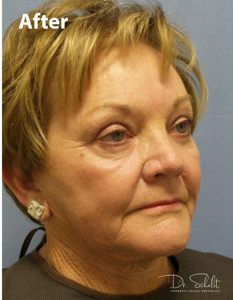 Face & Neck Lift 3 - Dr. Schalit Cosmetic Facial Specialist