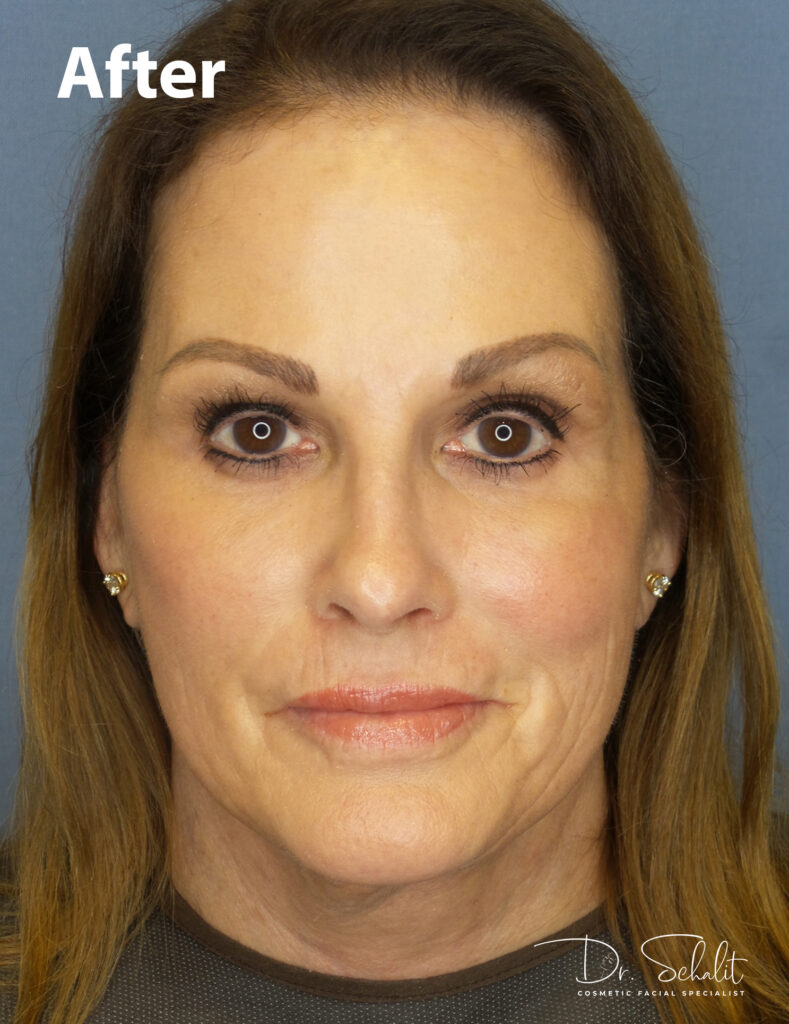 Face & Neck Lift 26 - Dr. Schalit Cosmetic Facial Specialist
