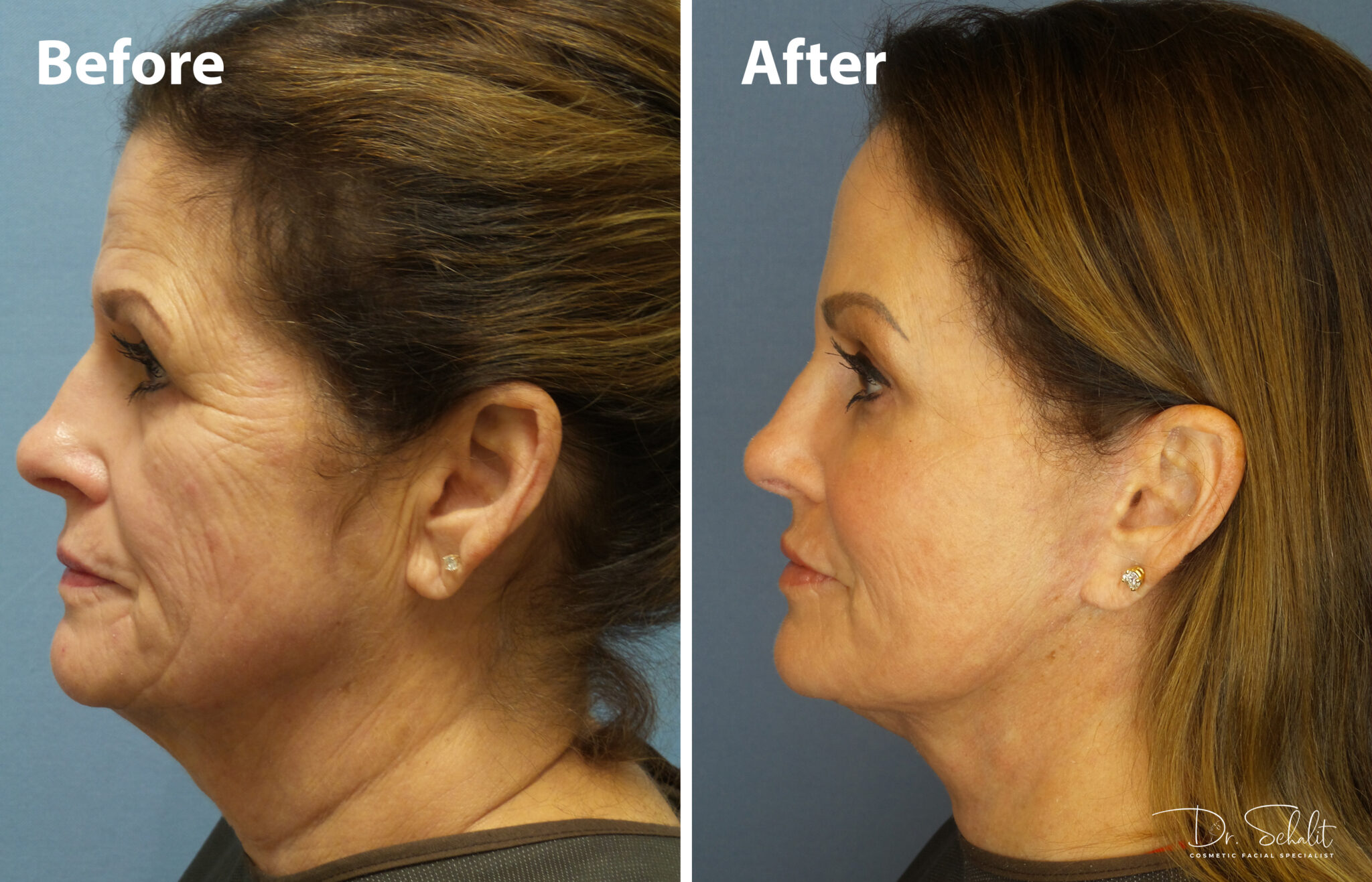 Face & Neck Lift 11 - Dr. Schalit Cosmetic Facial Specialist
