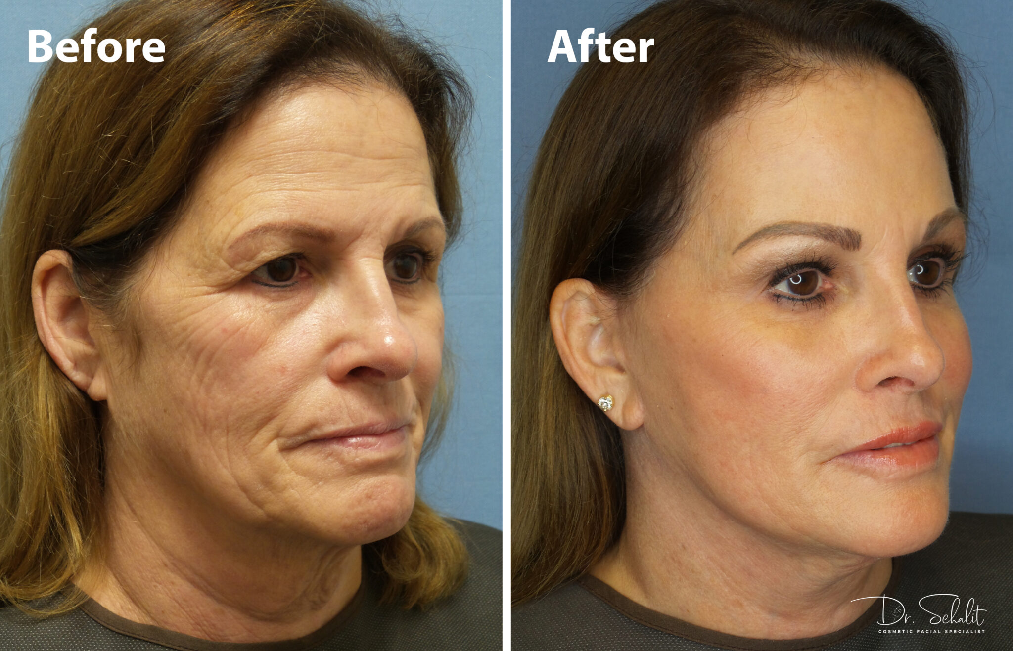 Face & Neck Lift 11 - Dr. Schalit Cosmetic Facial Specialist