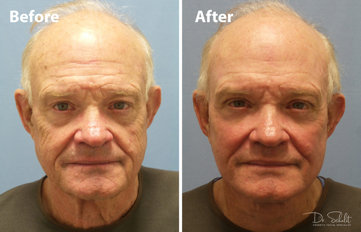 Face & Neck Lift 2 - Dr. Schalit Cosmetic Facial Specialist