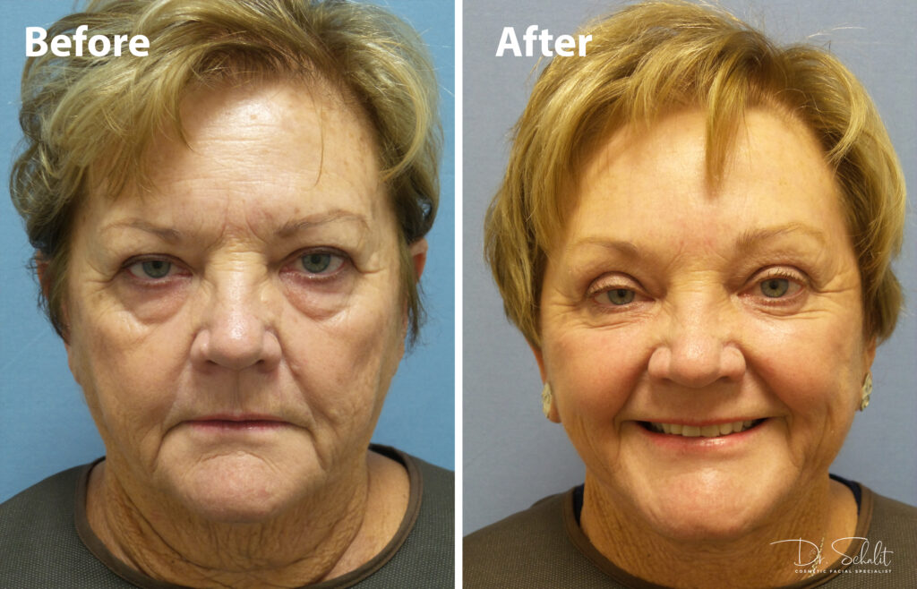 Face & Neck Lift 3 - Dr. Schalit Cosmetic Facial Specialist