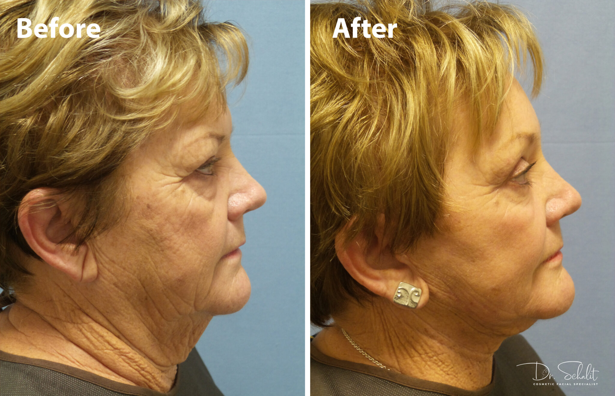 Face & Neck Lift 3 - Dr. Schalit Cosmetic Facial Specialist