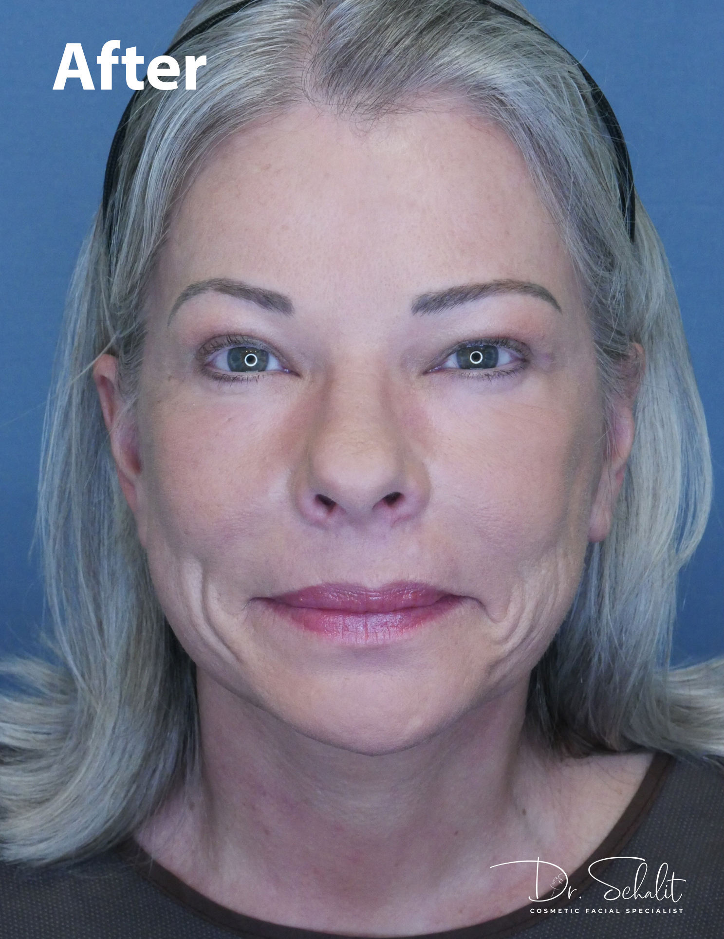 Face & Neck Lift 26 - Dr. Schalit Cosmetic Facial Specialist