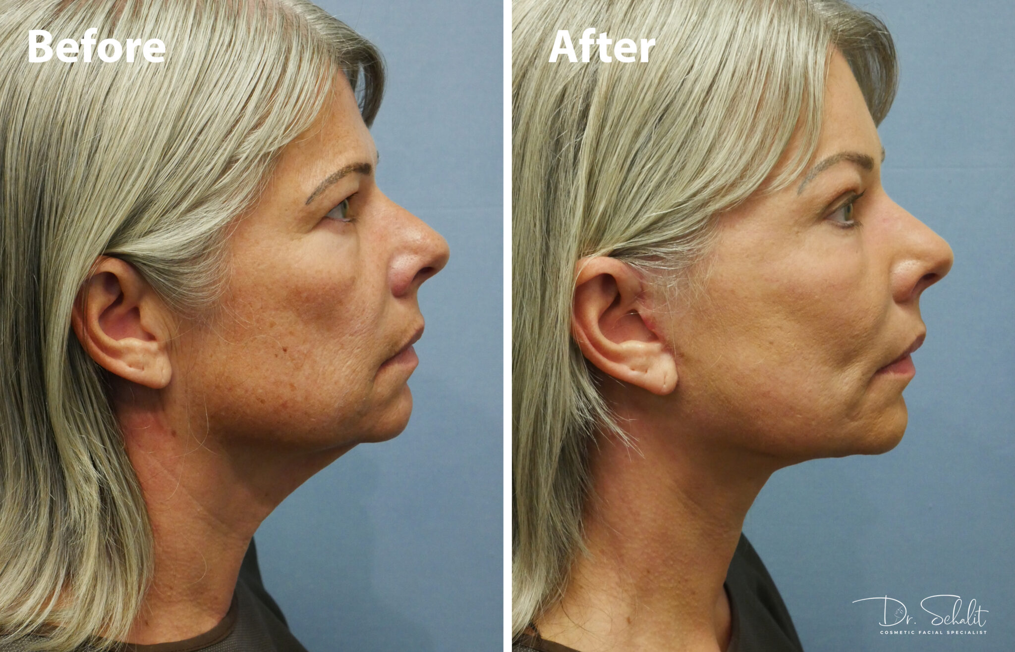 Face & Neck Lift 10 - Dr. Schalit Cosmetic Facial Specialist