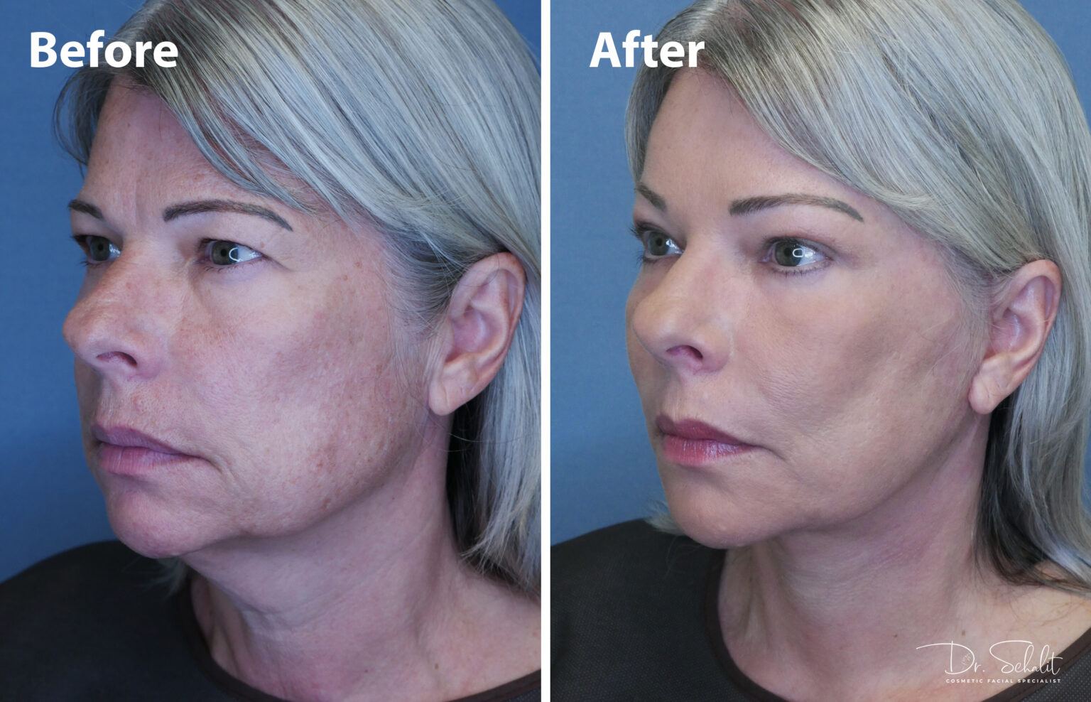 Face & Neck Lift 10 - Dr. Schalit Cosmetic Facial Specialist