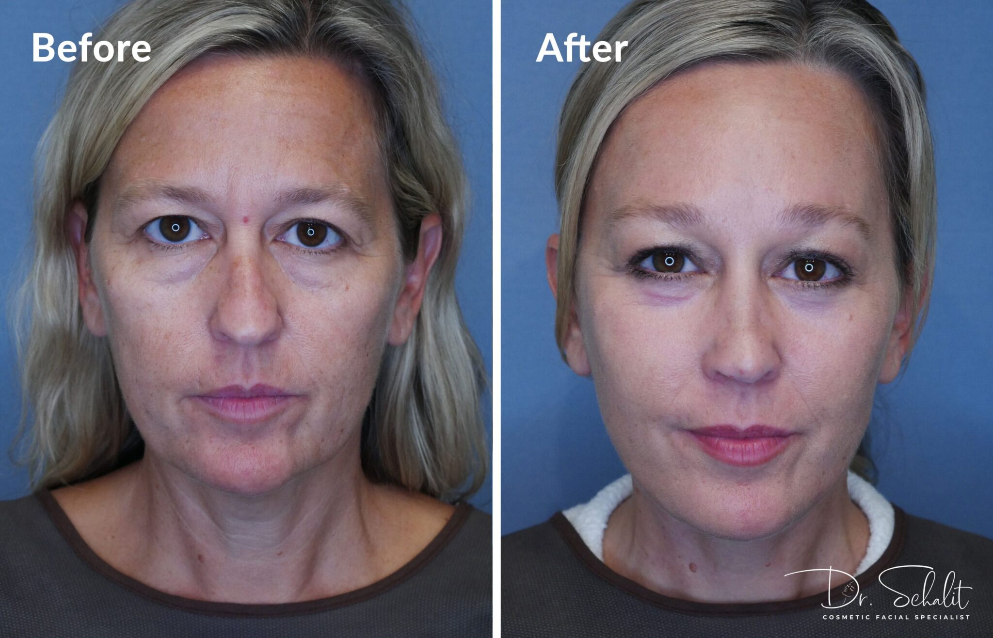 Face & Neck Lift 26 - Dr. Schalit Cosmetic Facial Specialist