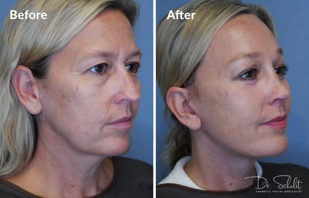 Face & Neck Lift 26 - Dr. Schalit Cosmetic Facial Specialist