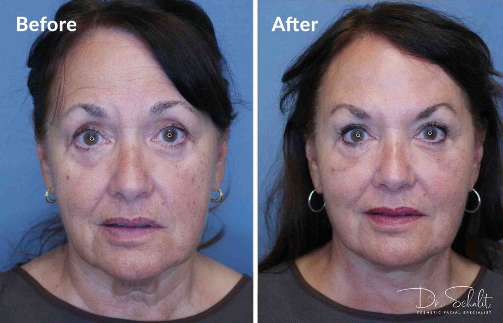 Face & Neck Lift 21 - Dr. Schalit Cosmetic Facial Specialist